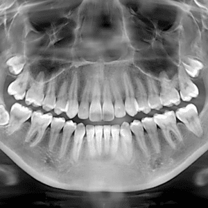 How does dental x-ray work and explain the types of dental x-rays?