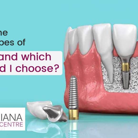 What are the benefits and types of undergoing temporary tooth bridges?