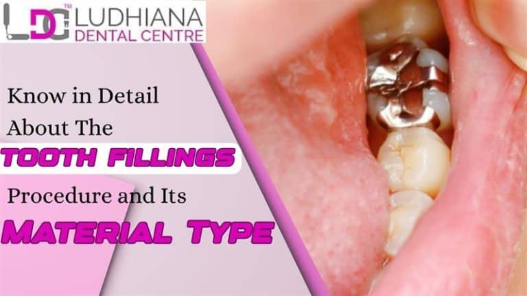 Tooth Fillings: Procedure & Types of Materials Explained